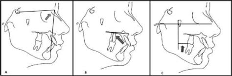 Representation Of The A Snb Angle B 6mx Ena Enp Angle C Download Scientific Diagram