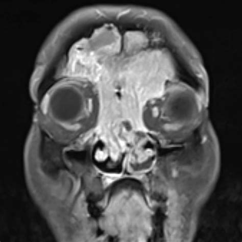 Pdf Frontal Sinus Inverted Papilloma Managed With Draf Iii