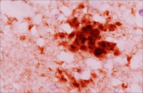 Heres How Dangerous Deadly Prions Spread To The Brain Live Science