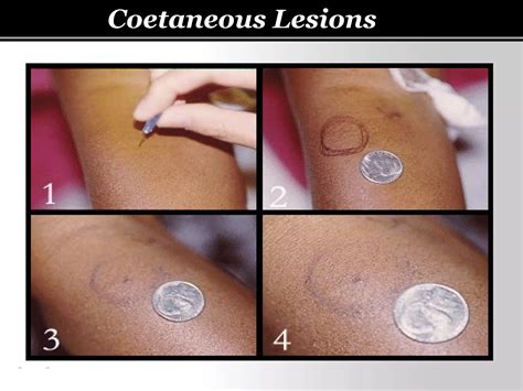 Behcets Disease Ppt