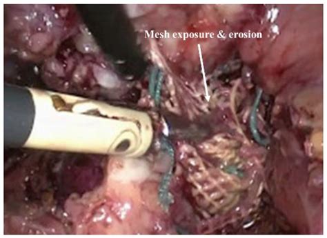 Mesh Exposure And Erosion Of Using Non Degradable Meshes In Pop