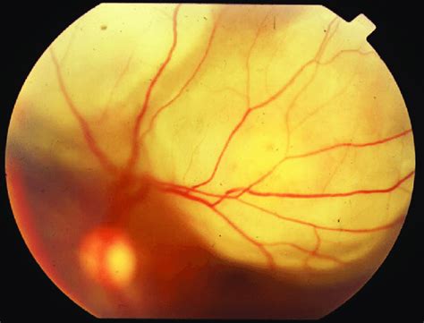 A Case Of A 34‑year‑old Female Diagnosed As A Case Of Subretinal