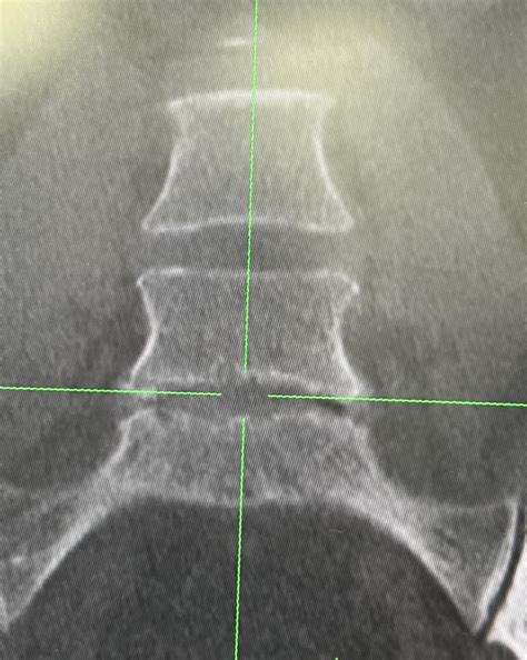 Puerto Puerto Rico Spine Center Dr Yamil C Rivera Colon