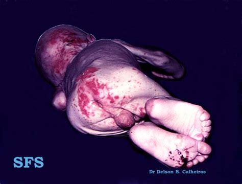 Acrodermatitis Enteropathica Nc Commons