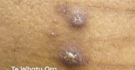 Reactive Perforating Collagenosis Image