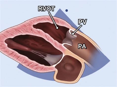 Plax Parasternal Long Axis Echocardiography Views