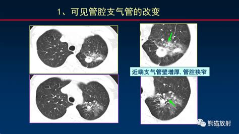 【ppt】hrct对肺结核细节的观察进展 影像ppt 【ppt】hrct对肺结核细节的观察进展 影像ppt