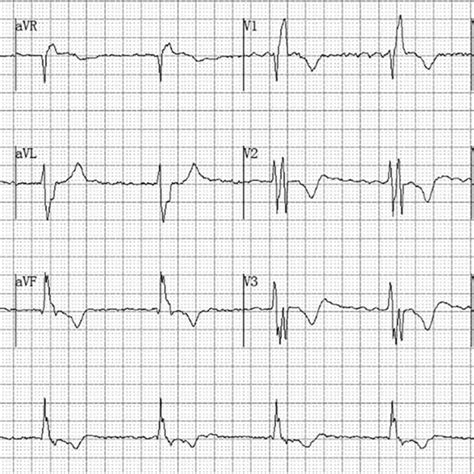 Ecg After Operation Paced Rhythm Left Anterior Fascicular Block