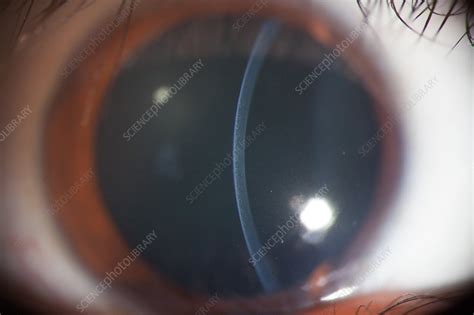 Cornea Slit Lamp Stock Image C0434137 Science Photo Library