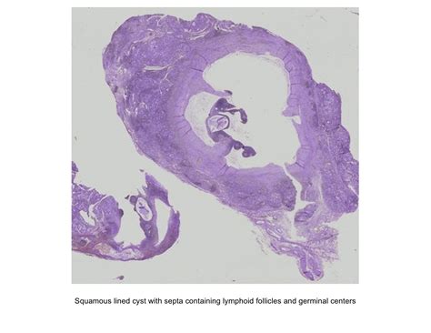 Pathology Outlines Hashimoto Thyroiditis