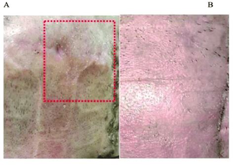 A The Xerosis Of One Gbm Patient Before Managing B The Scalp Download Scientific Diagram