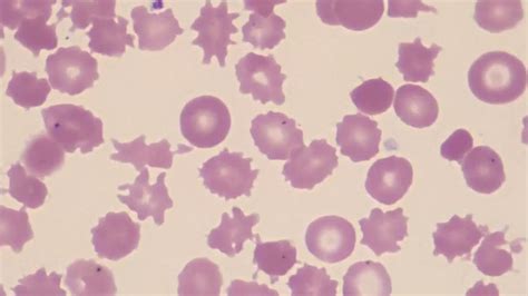 Echinocytes