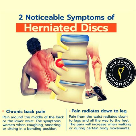 Disc Herniation Also Known As A Slipped Or Bulging Disc Occurs When The Soft Inner Core Of A