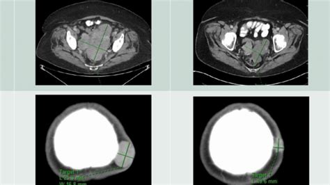 Sarcoma Symptoms And Diagnosis Herbert Irving Comprehensive Cancer