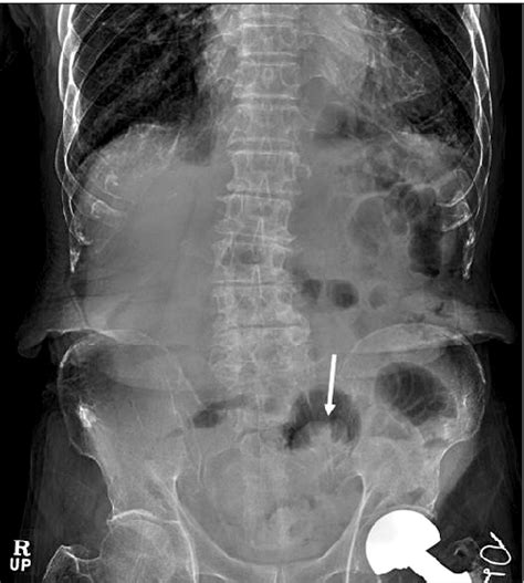 Figure 1 From Small Bowel Obstruction Due To Enterolith Semantic