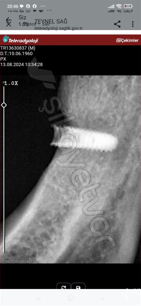 Osstem Implant Osstem Implant Osstem İmplant Hakkında Şikayetvar