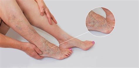 Enhance Vascular Health Recognise Causes Of Varicose Veins