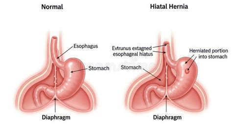 Hiatal Hernia Compared To Normal Stomach Anatomy Diagram Stock