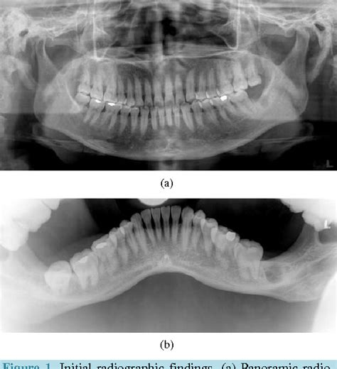 Mental Foramen Radiograph