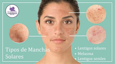 Manchas Solares En La Piel