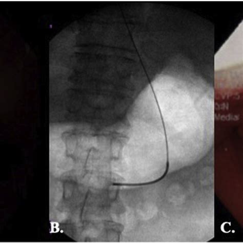 A Esophagoscopy Showed The Stricture With Normal Mucosa B Under Download Scientific Diagram