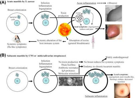 Cure For Staphylococcus Aureus