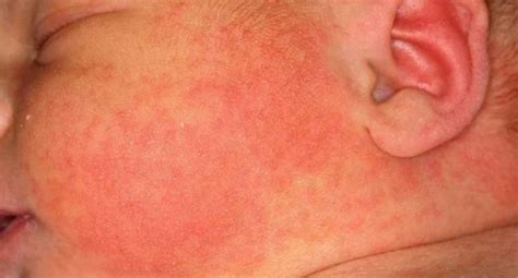 Bubițe Pe Față La Bebeluși Soluții Pentru Acneea Neonatală