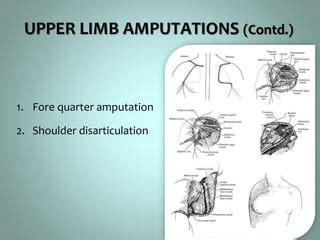 Amputations Presentationpptx