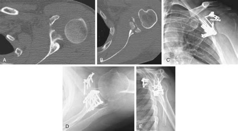 Scapula Fractures Clinical Tree