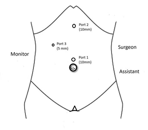 A Study Of Laparoscopic Simple Or Complex Cholecystectomy With Or