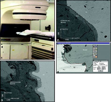 Histomorphometric Analysis Of Ha Coated Implants Interface W Implant Dentistry