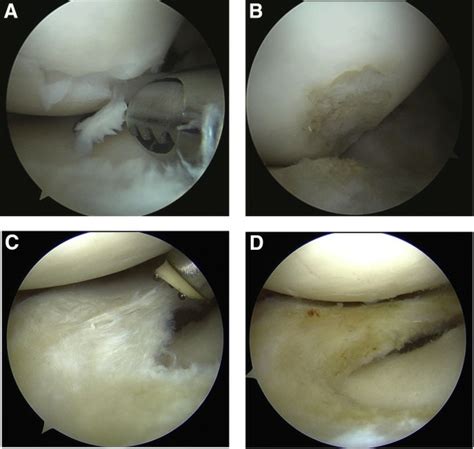 What Is Knee Arthroscopy د عبد الحميد سيد عيسى