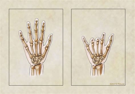 Red Right Hand Ectrodactyly As A Metaphor Hektoen International