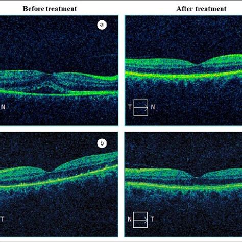 Macular Optical Coherence Tomography Imaging A B Exudative Retinal