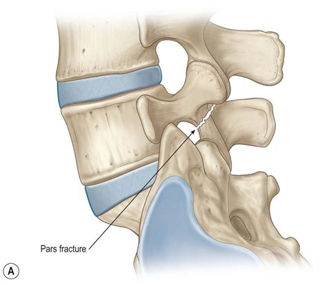 Lumbar Spine Sacrum And Coccyx Clinical Tree