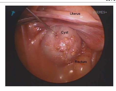 Perirectal Cyst