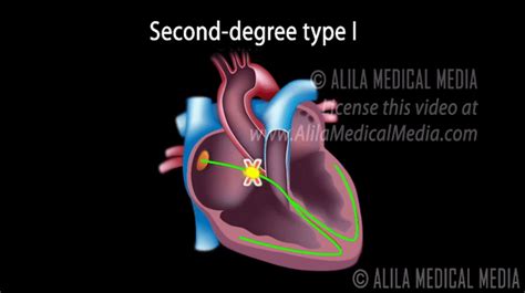 Atrioventricular Block Av Block Types Of Heart Block Part 2