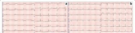 Electrocardiogram Ecg After Administration Of Paclitaxel A Ecg