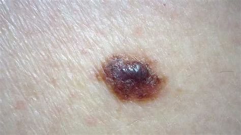 Mucosal Lentiginous Melanoma