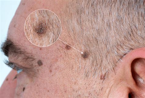 How To Recognize Dangerous Moles Buckhead Clinic Atlanta Ga