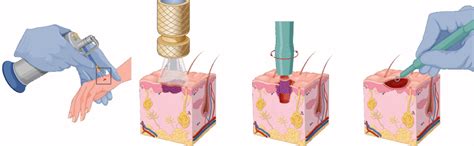 Mole Removal Experts And Lesion Treatment In Auckland Skintel Clinic
