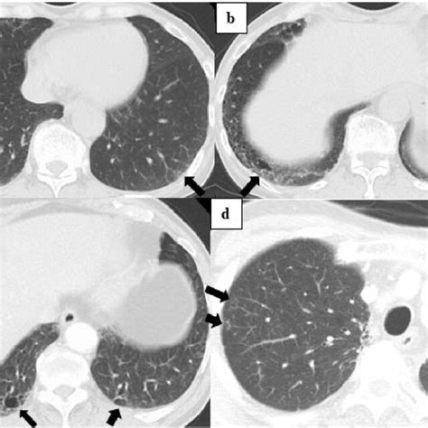 Examples Of Interstitial Lung Abnormalities With Arrows Indicating A Download Scientific