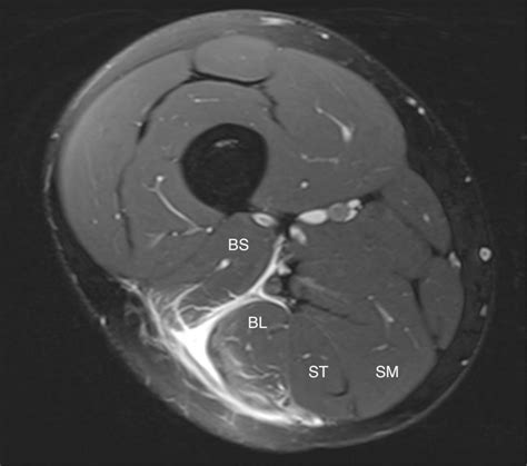 Association Of The British Athletic Muscle Injury Classification And