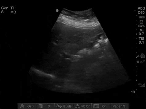 Gallbladder Bcpocus