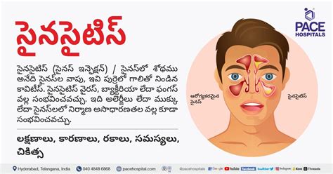 సైనసైటిస్ సైనస్ ఇన్ఫెక్షన్ లక్షణాలు కారణాలు రకాలు చికిత్స