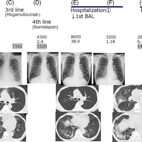Clinical Course A Chop Therapy Was Started As The First‐line