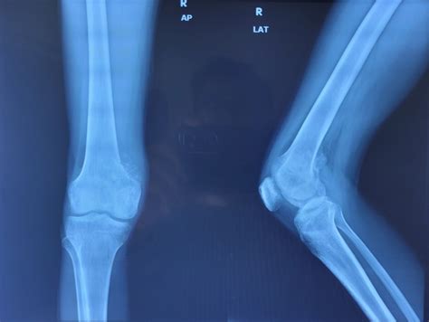 Case Of Osteosarcoma Of Thigh Bone Way To Heal