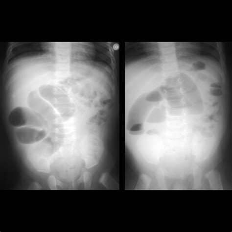 Ileocolic Intussusception Pediatric Radiology Reference Article