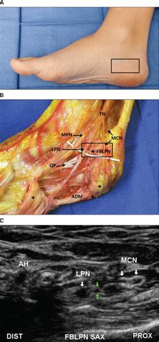 Sonographic Visualization Of The First Branch Of The Lateral Plantar