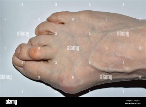 The Picture Shows A Top View Of The Right Foot Of A Woman Affected By